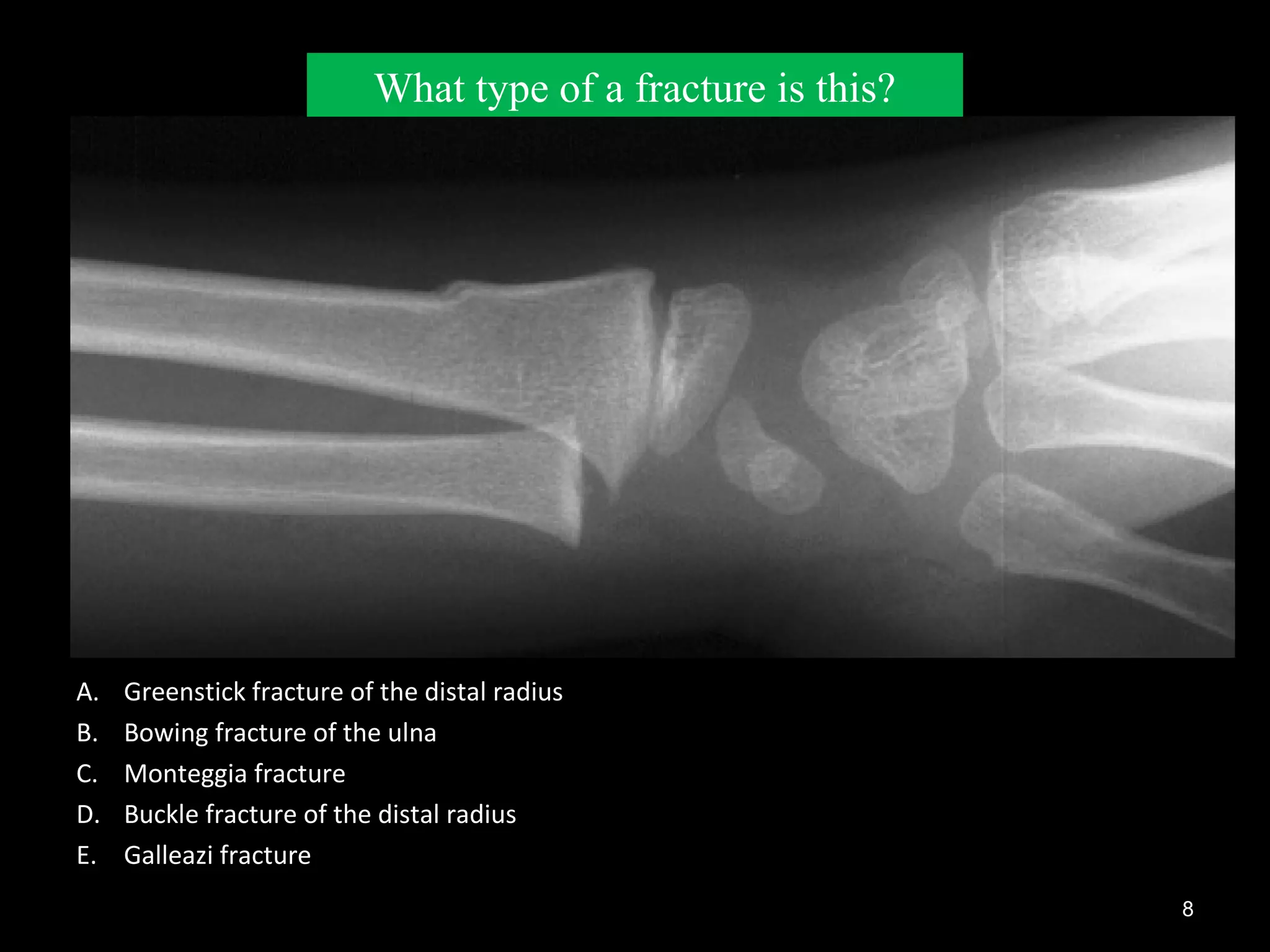 Paediatric Fractures for SCH ED | PPT