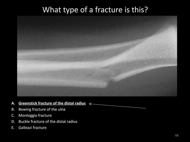 Paediatric Fractures for SCH ED | PPT