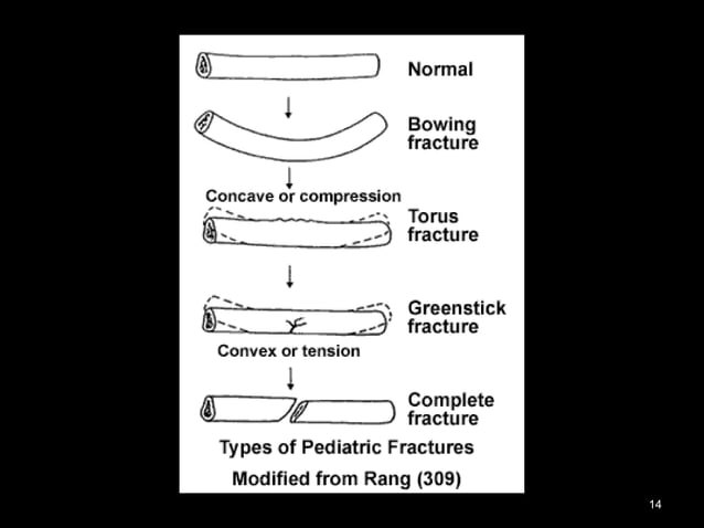 Paediatric Fractures for SCH ED | PPT