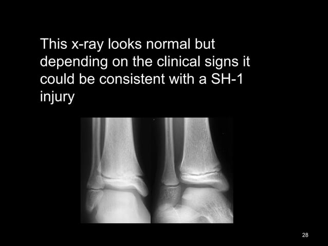 Paediatric Fractures for SCH ED | PPT