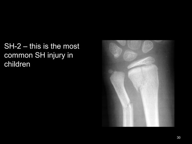 Paediatric Fractures for SCH ED | PPT