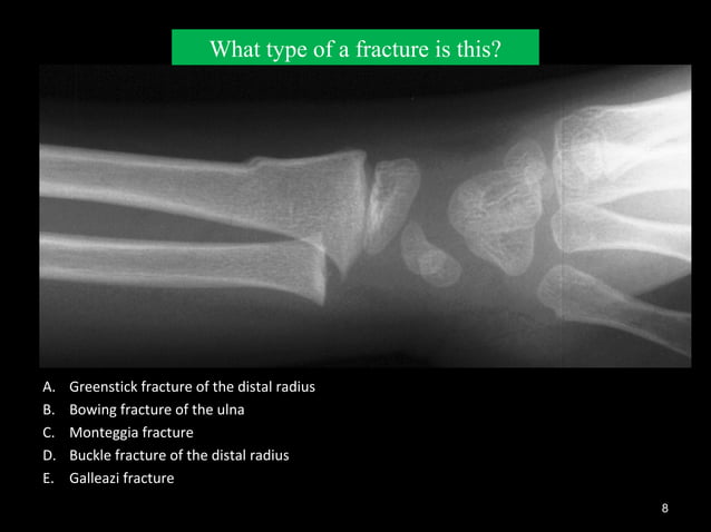 Paediatric Fractures for SCH ED | PPT