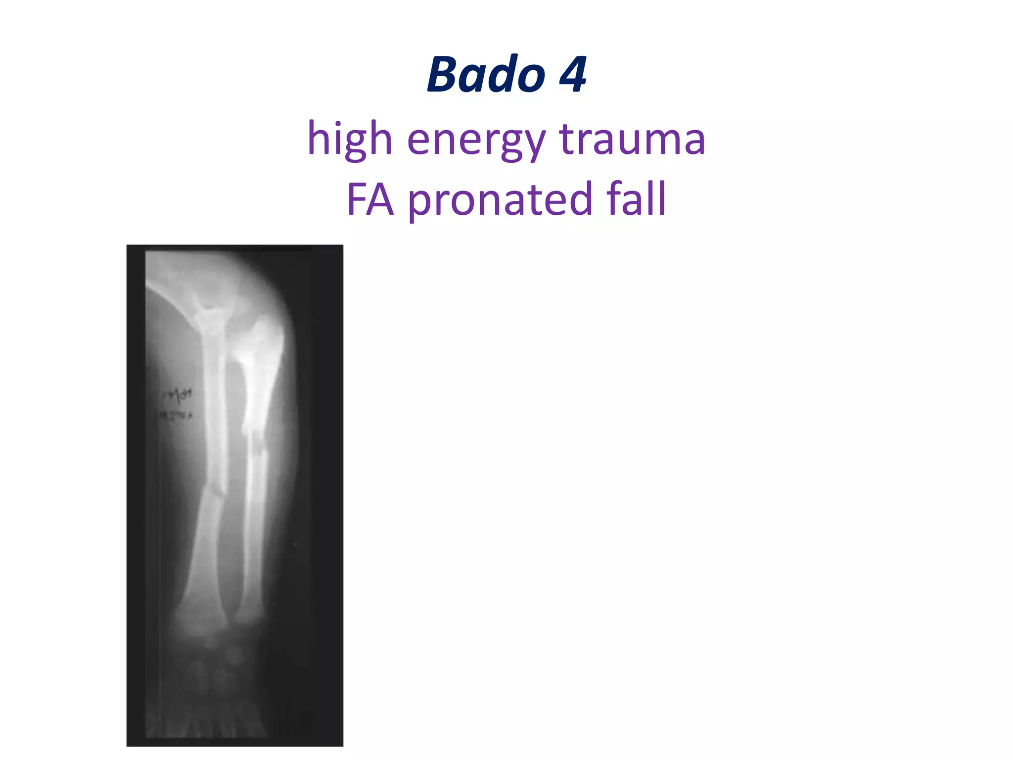 paediatric monteggia fracture dr mohamed ashraf alleppey kerala india.pptx