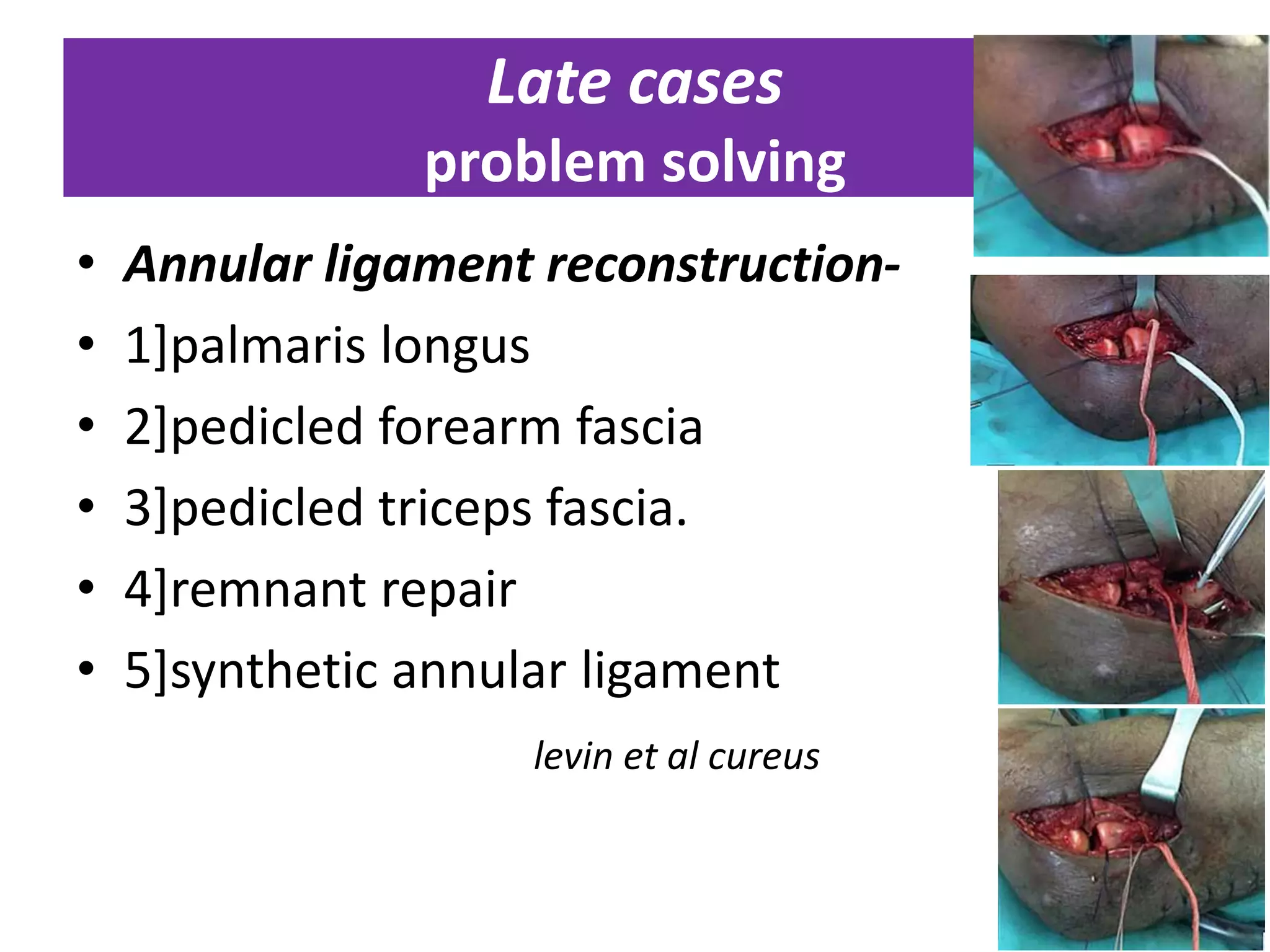 paediatric monteggia fracture dr mohamed ashraf alleppey kerala india.pptx