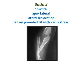 paediatric monteggia fracture dr mohamed ashraf alleppey kerala india.pptx