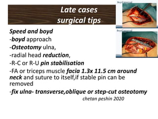 paediatric monteggia fracture dr mohamed ashraf alleppey kerala india.pptx