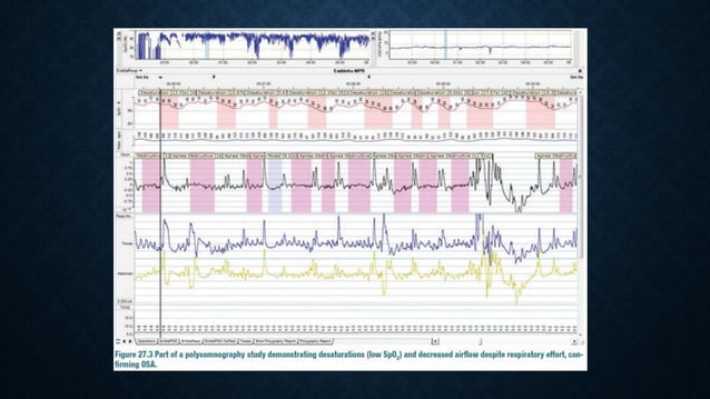 Paediatric osa final | PPTX | Ear, Nose and Throat Conditions ...