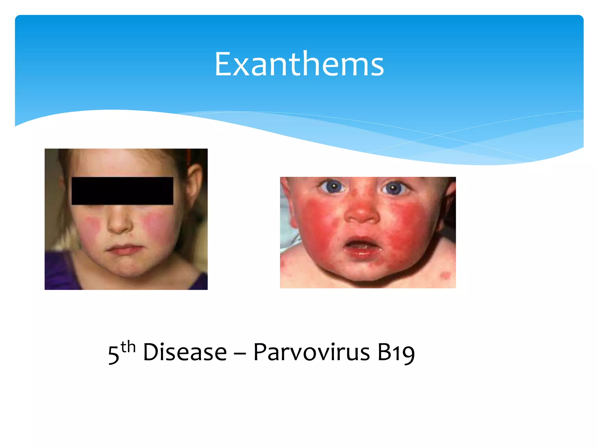 Paediatric rashes | PPTX