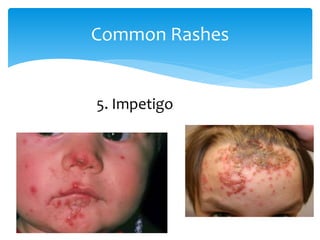 Paediatric rashes | PPTX