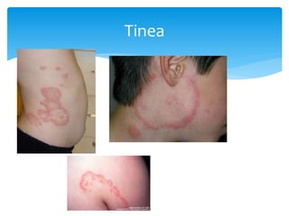 Paediatric rashes | PPTX