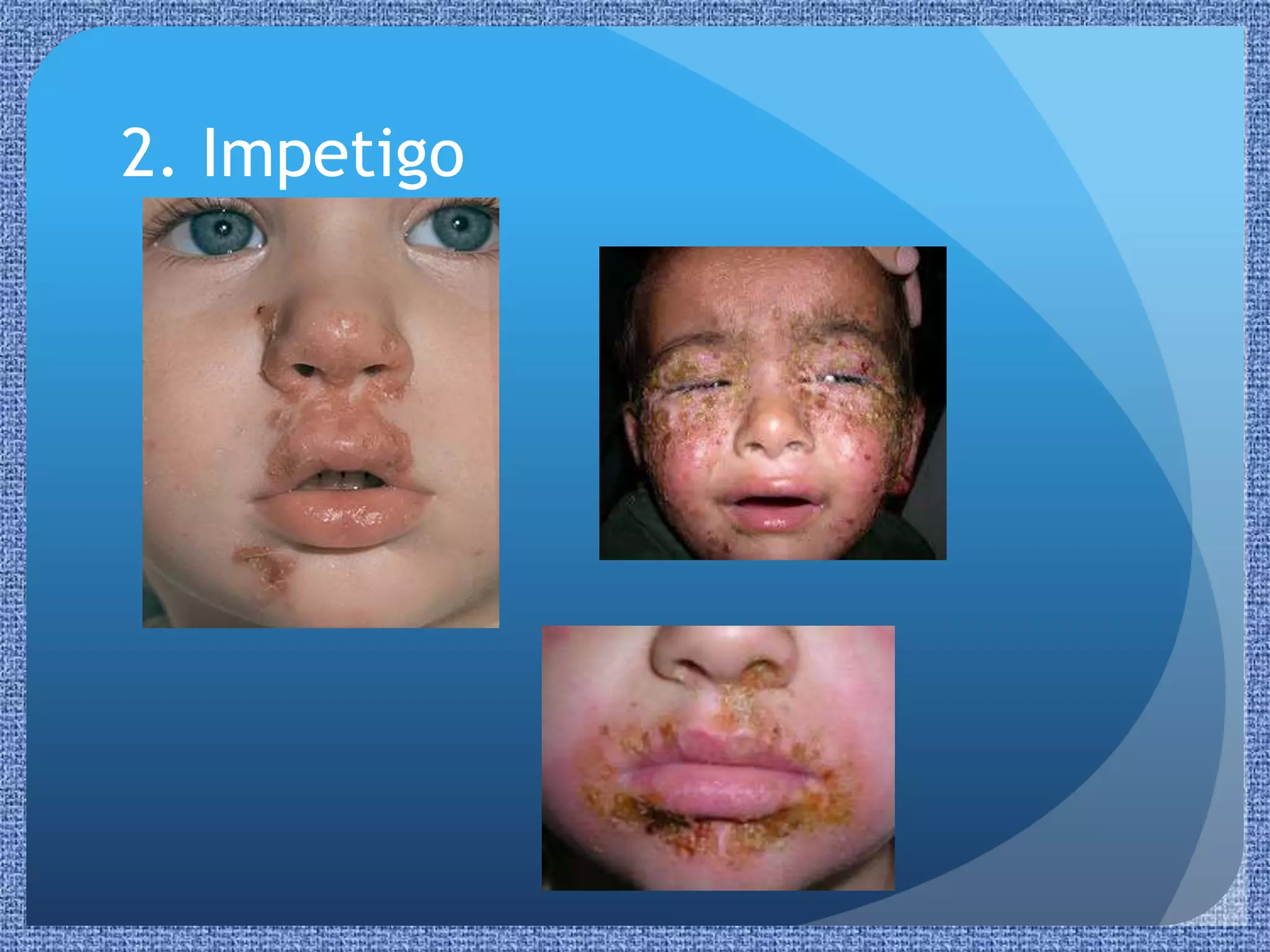 Paediatric Rashes | PPTX