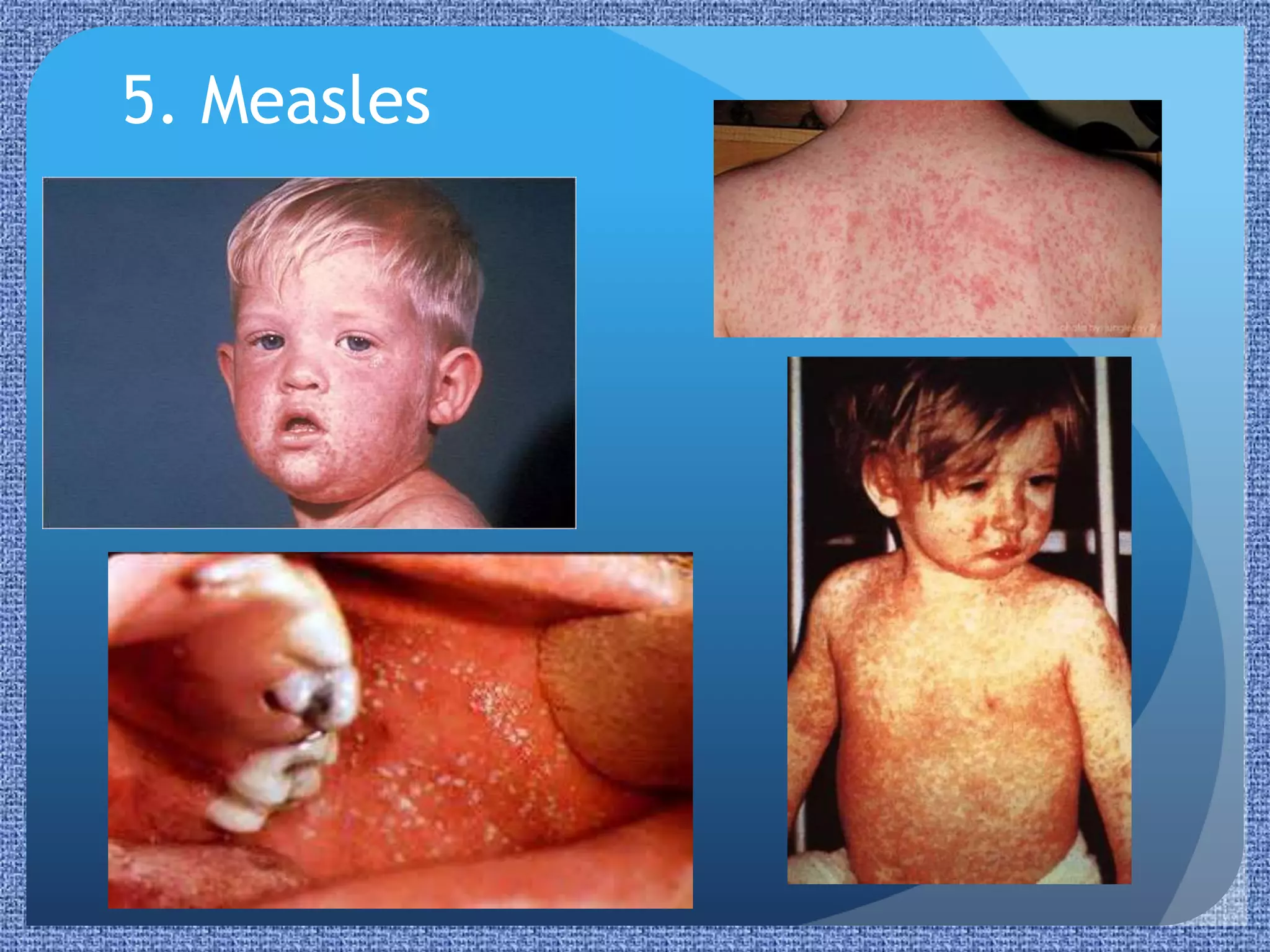 Paediatric Rashes | PPTX