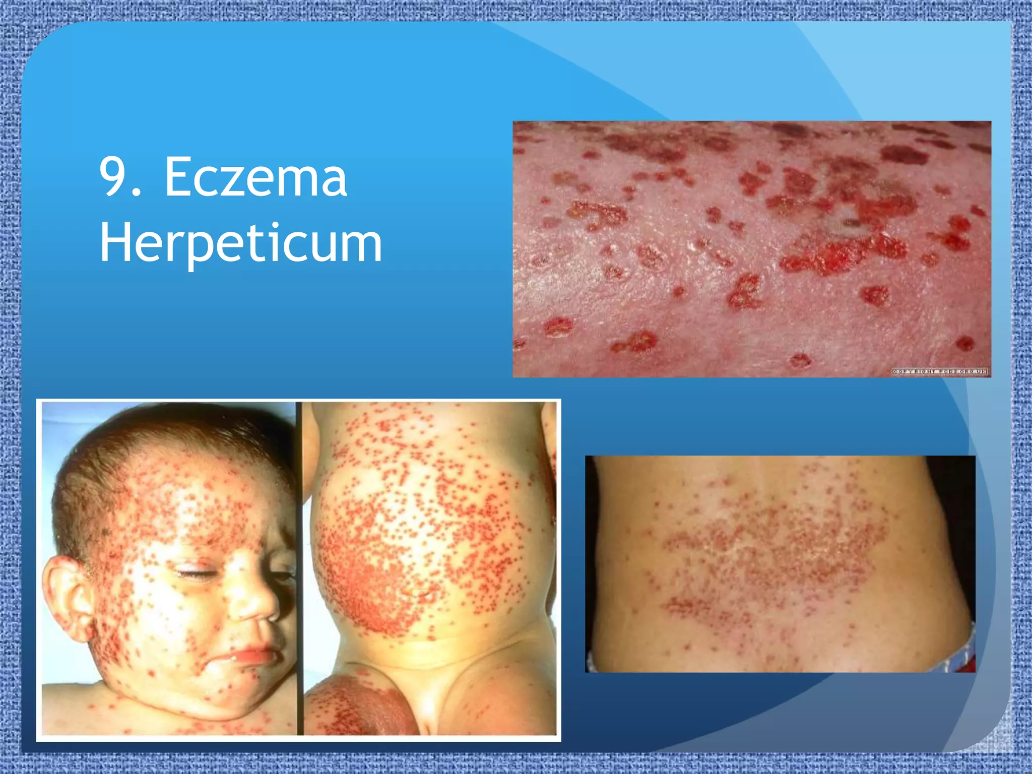 Paediatric Rashes | PPTX