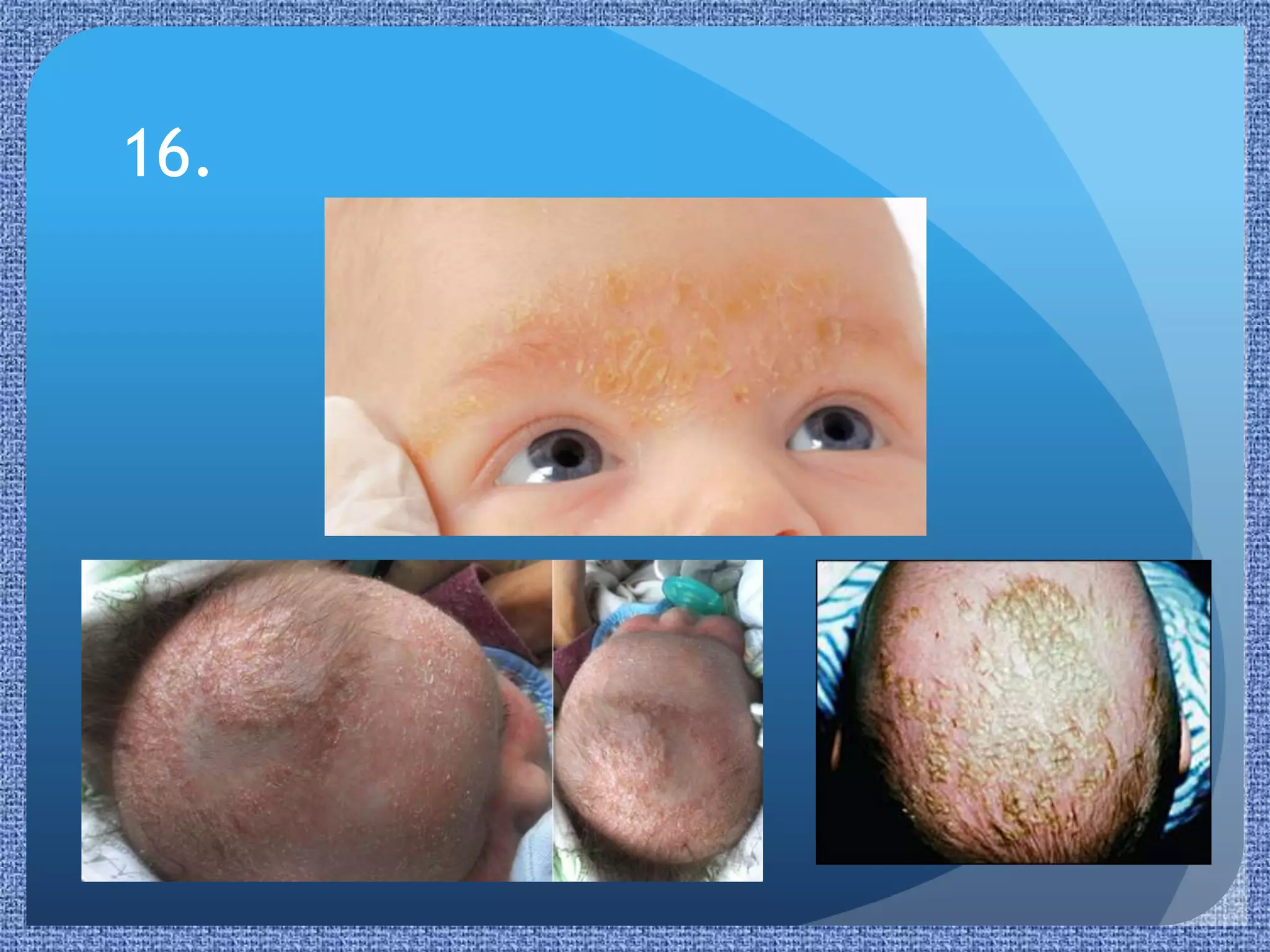 Paediatric Rashes | PPTX