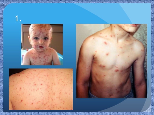 Paediatric Rashes | PPTX | Infectious Diseases | Diseases and Conditions