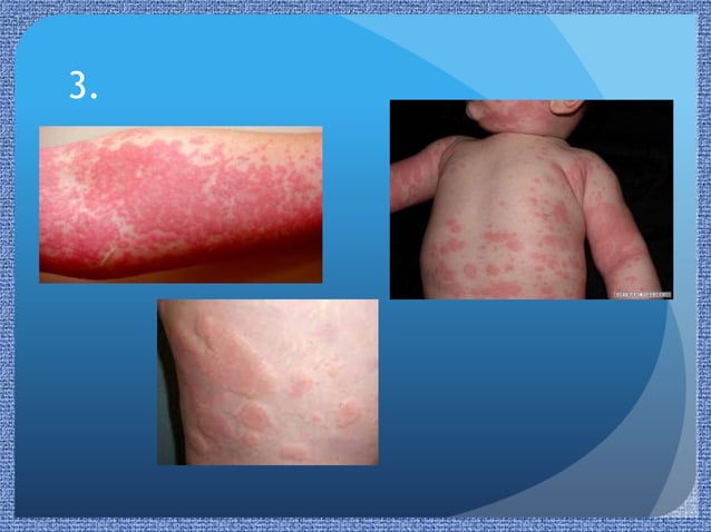 Paediatric Rashes | PPTX | Infectious Diseases | Diseases and Conditions