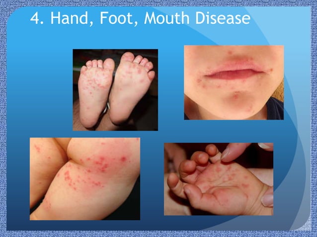 Paediatric Rashes | PPTX | Infectious Diseases | Diseases and Conditions
