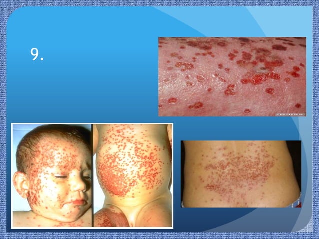 Paediatric Rashes | PPTX | Infectious Diseases | Diseases and Conditions