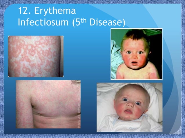 Paediatric Rashes | PPTX | Infectious Diseases | Diseases and Conditions