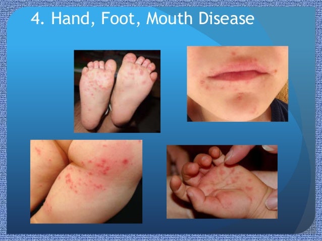 Paediatric Rashes
