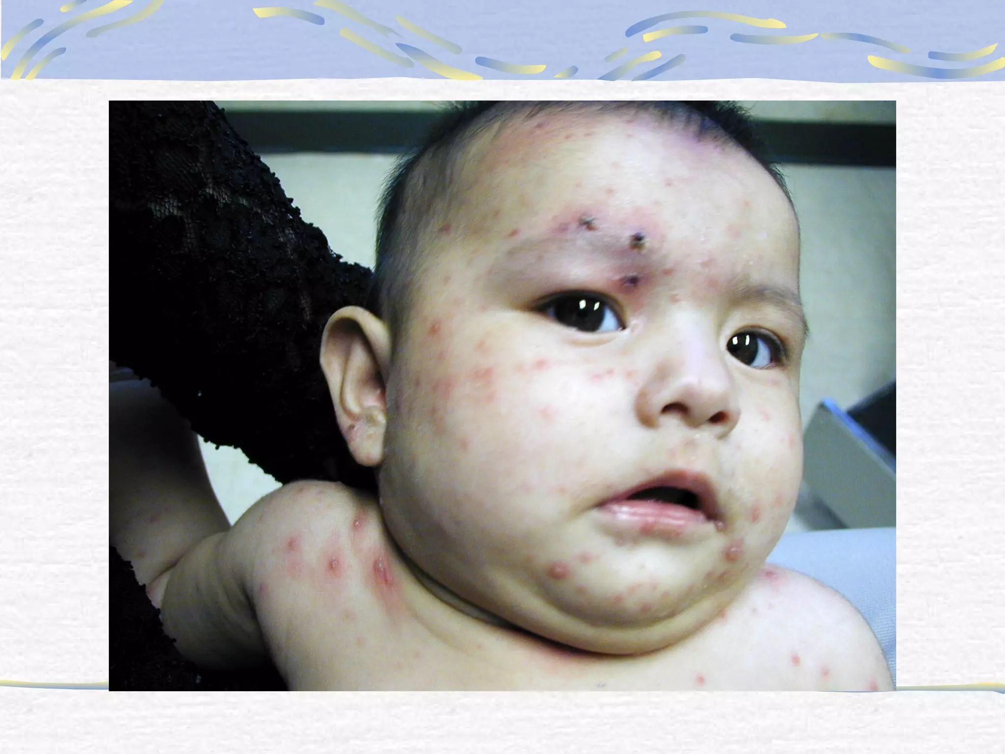 Paediatric rash | PPT