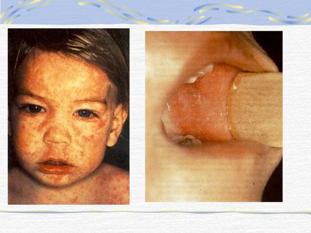 Paediatric rash | PPT | Free Download