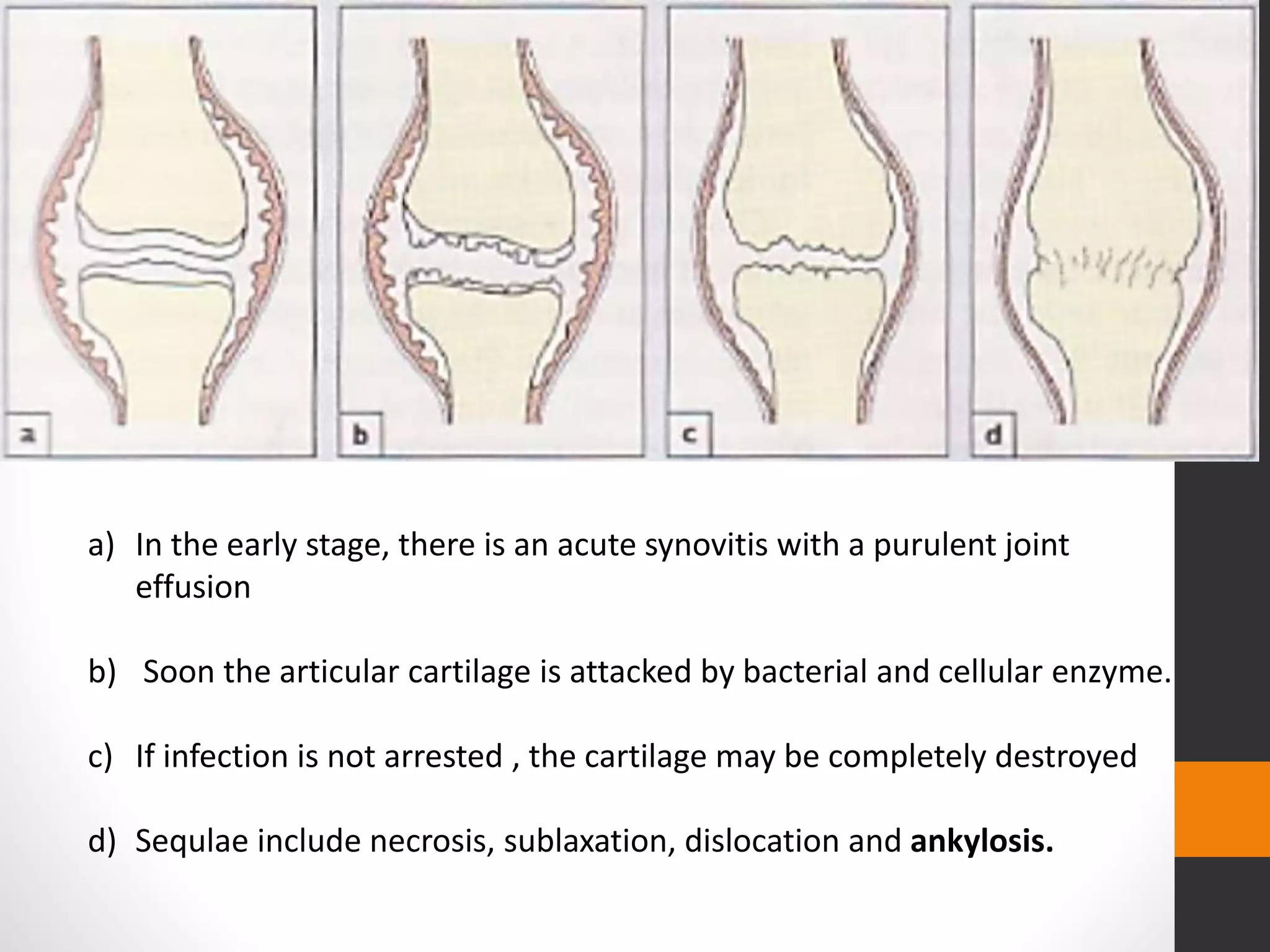 Paediatric Septic Arthritis | PPTX