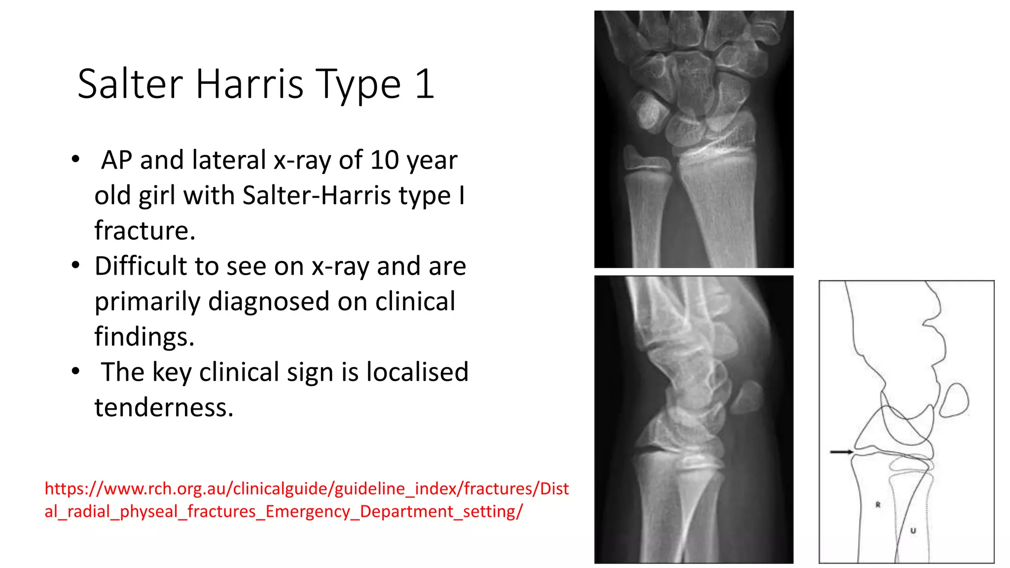 Paediatrics fracture | PPTX