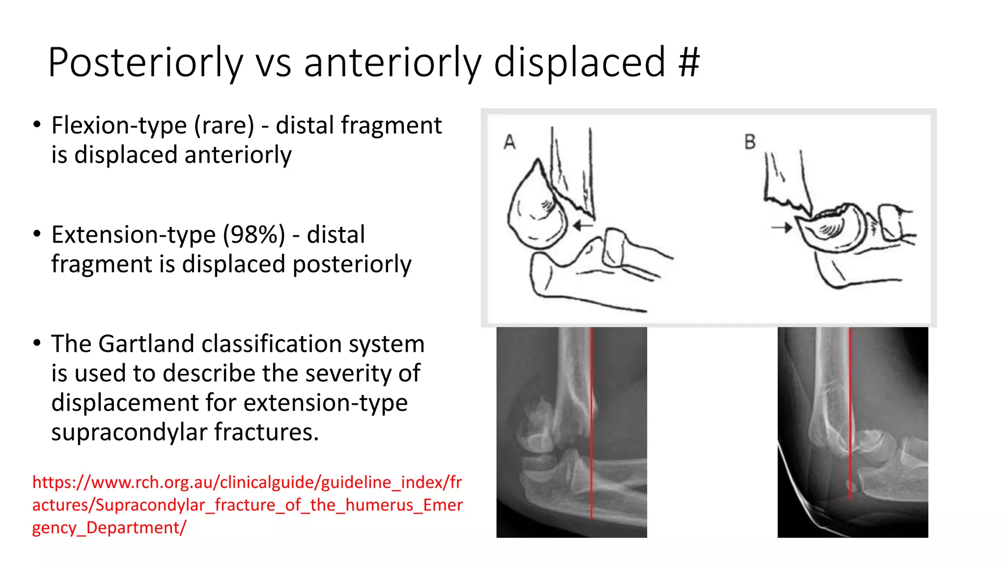 Paediatrics fracture | PPTX