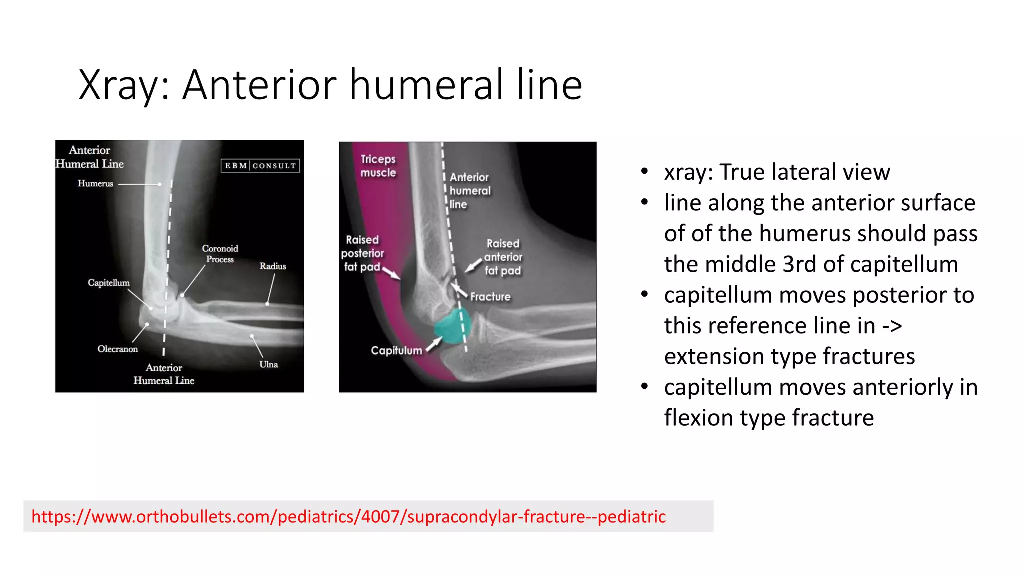 Paediatrics fracture | PPTX