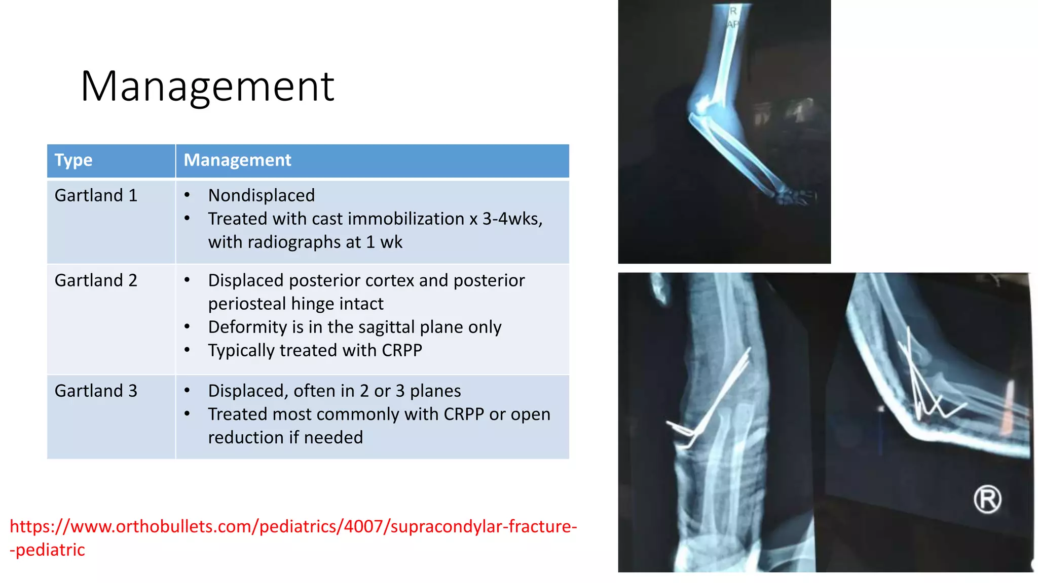 Paediatrics fracture | PPTX