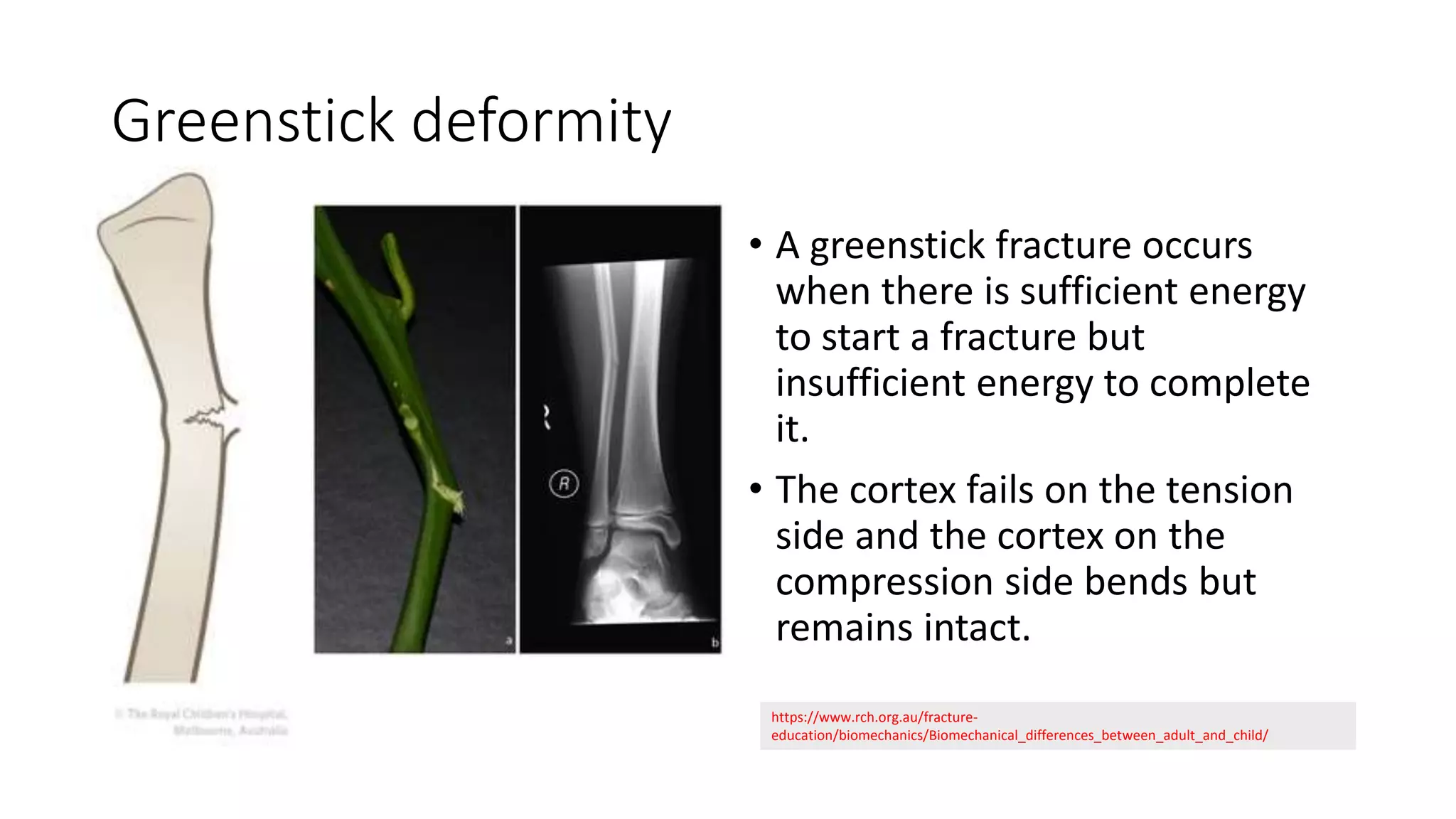 Paediatrics fracture | PPTX