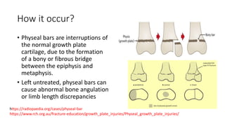 Paediatrics fracture | PPTX