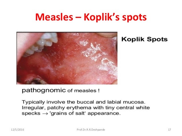 Rubeola Koplik Spots