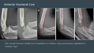 PAEDIATRIC SUPRACONDYLAR HUMERAL FRACTURES.pptx