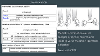 PAEDIATRIC SUPRACONDYLAR HUMERAL FRACTURES.pptx