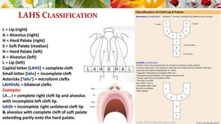 Pediatric Surgery 2 - Cleft lip & palate / TOF / Hypospadias ...