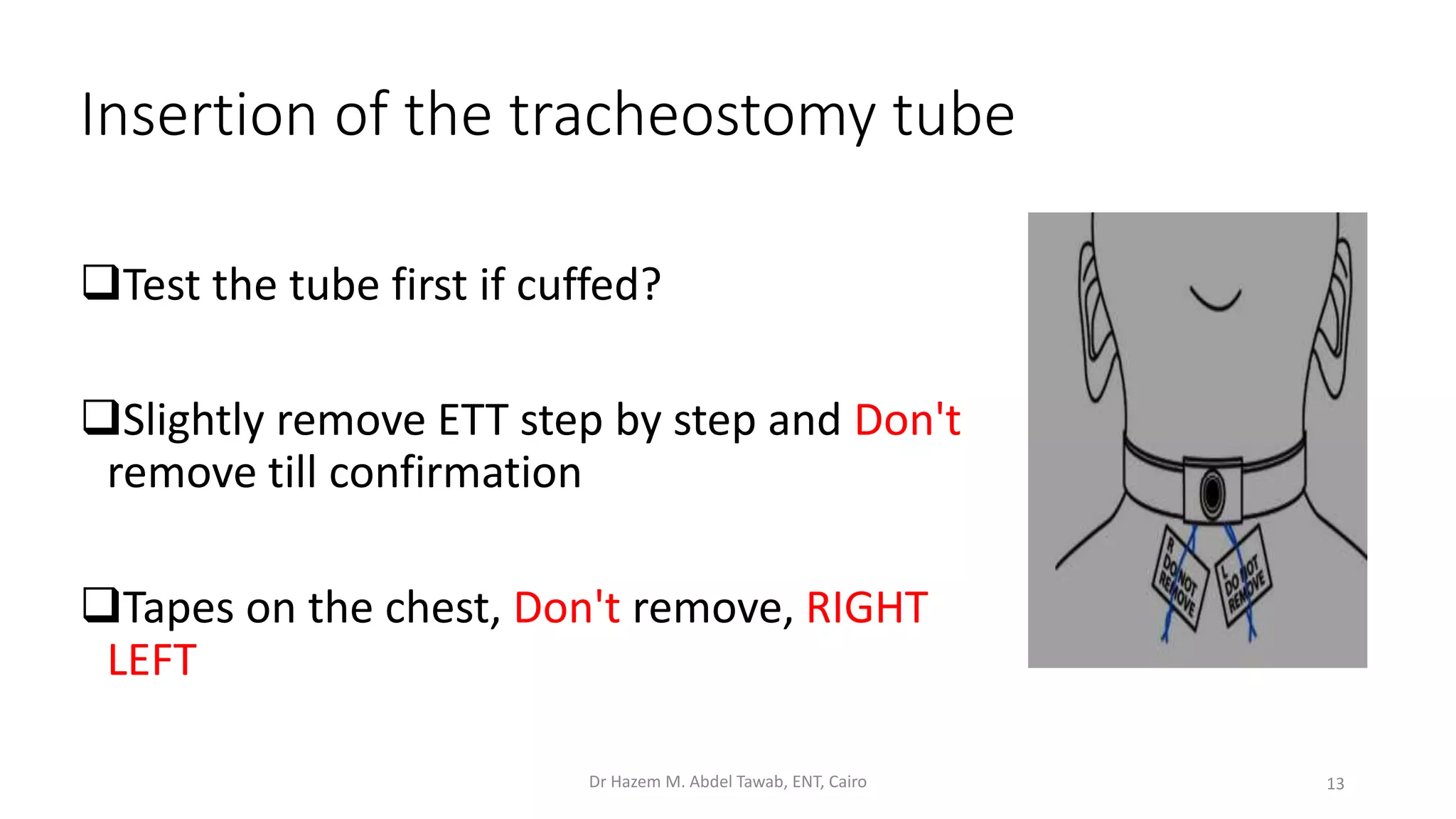 Paediatric tracheostomy | PPTX