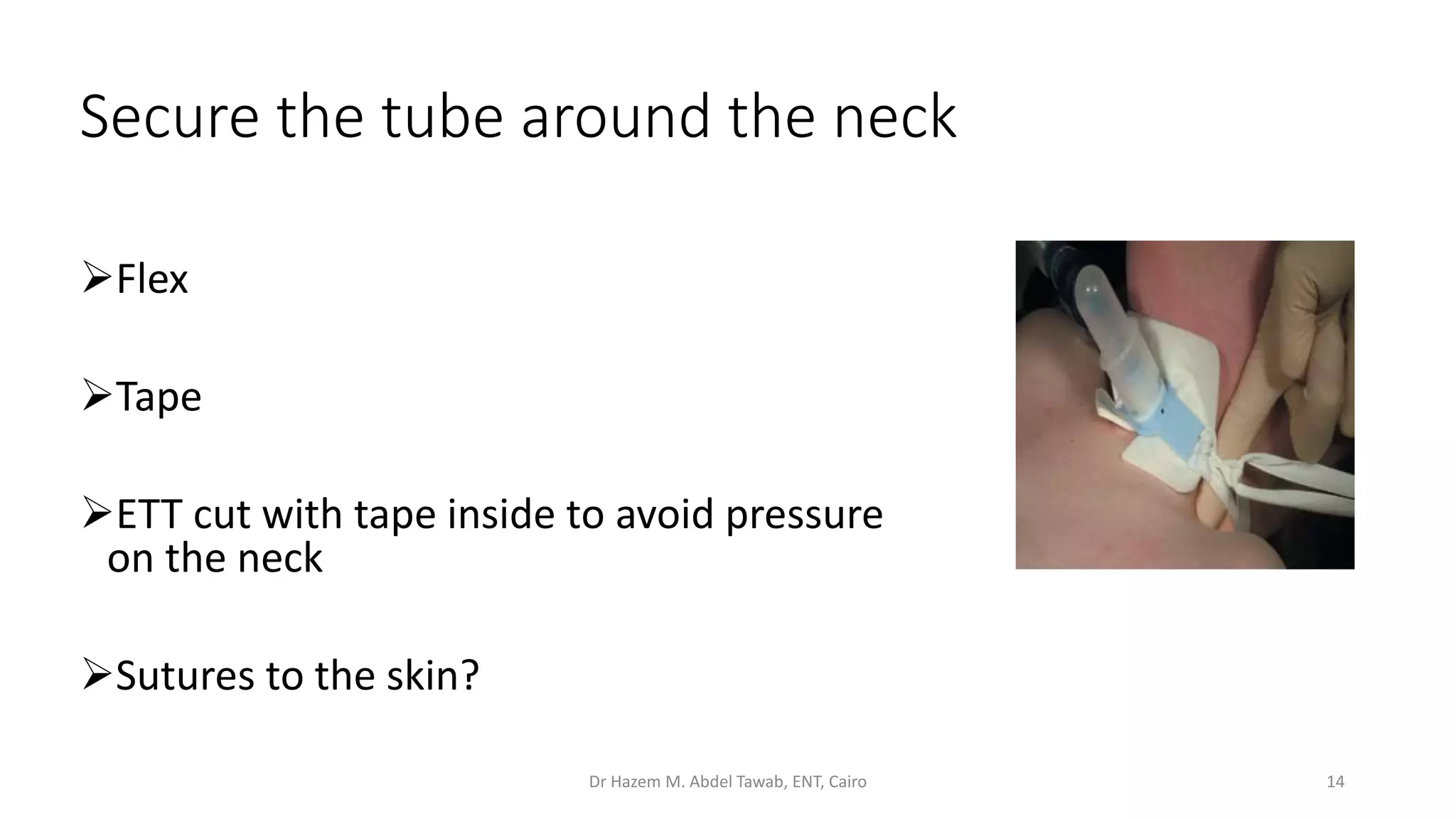 Paediatric tracheostomy | PPTX
