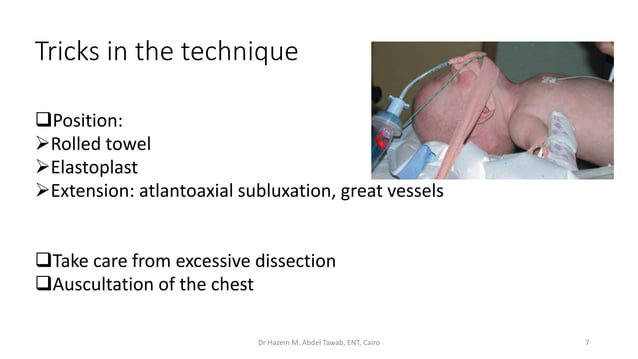 Paediatric tracheostomy | PPTX