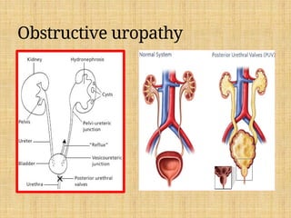 Understanding Pediatric Urinary Tract Infections: Causes, Symptoms, and ...