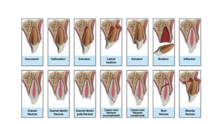 Paedo Lecture - Trauma to Anterior Teeth in Children.pdf