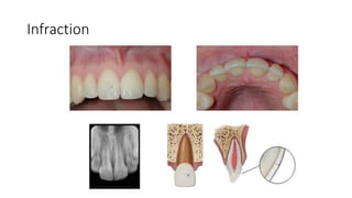 Paedo Lecture - Trauma to Anterior Teeth in Children.pdf