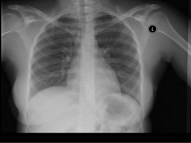 Paeds chest x ray