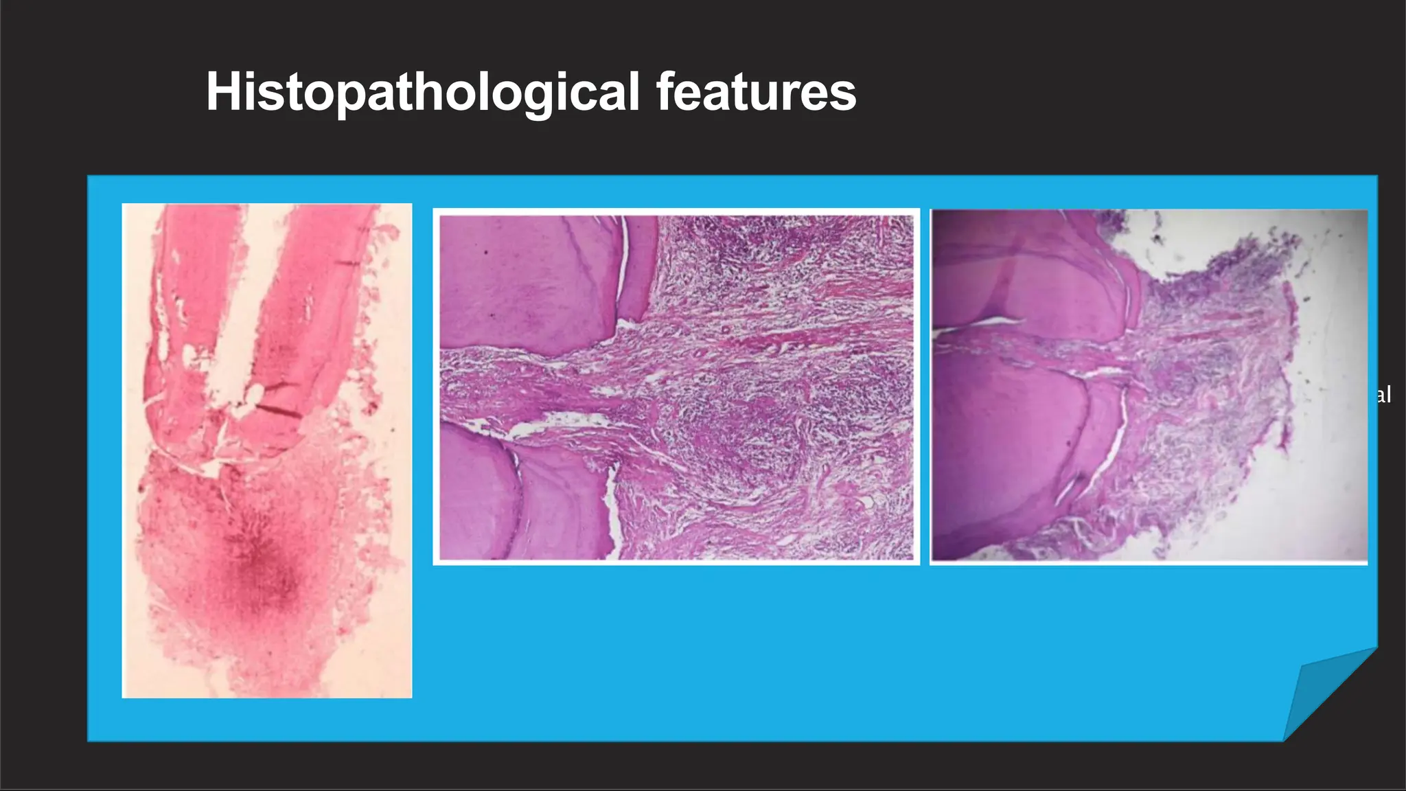 periapical granuloma .pptx
