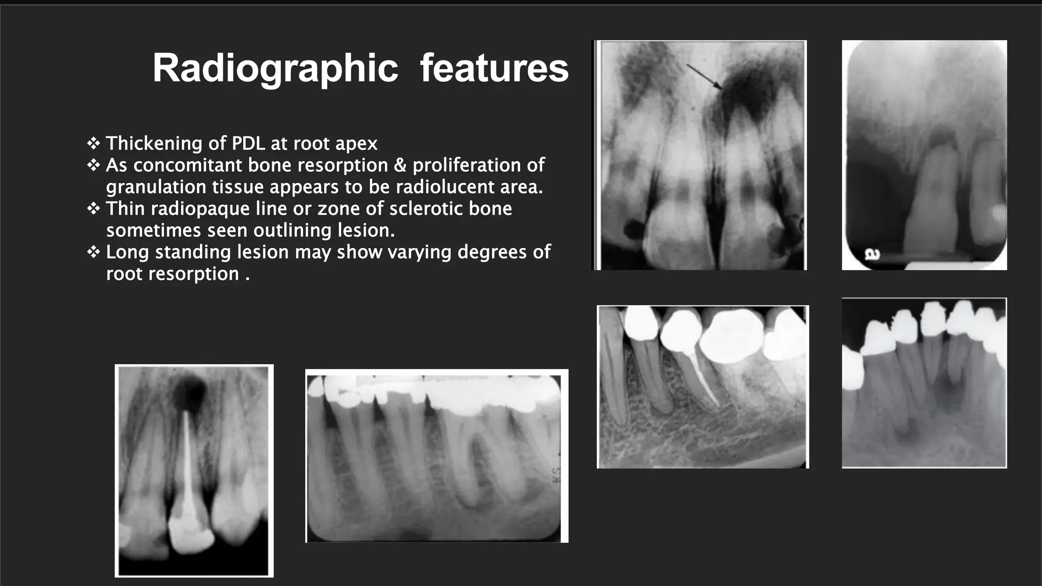 periapical granuloma .pptx