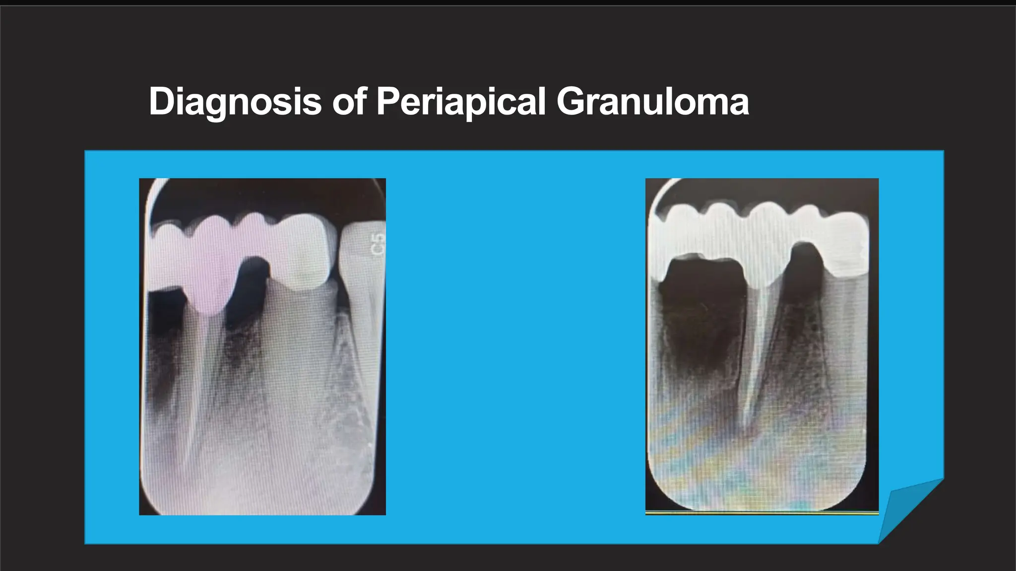 periapical granuloma .pptx