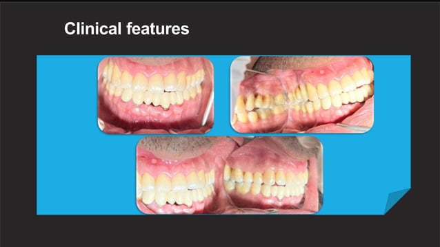 periapical granuloma .pptx | Dental Health | Diseases and Conditions
