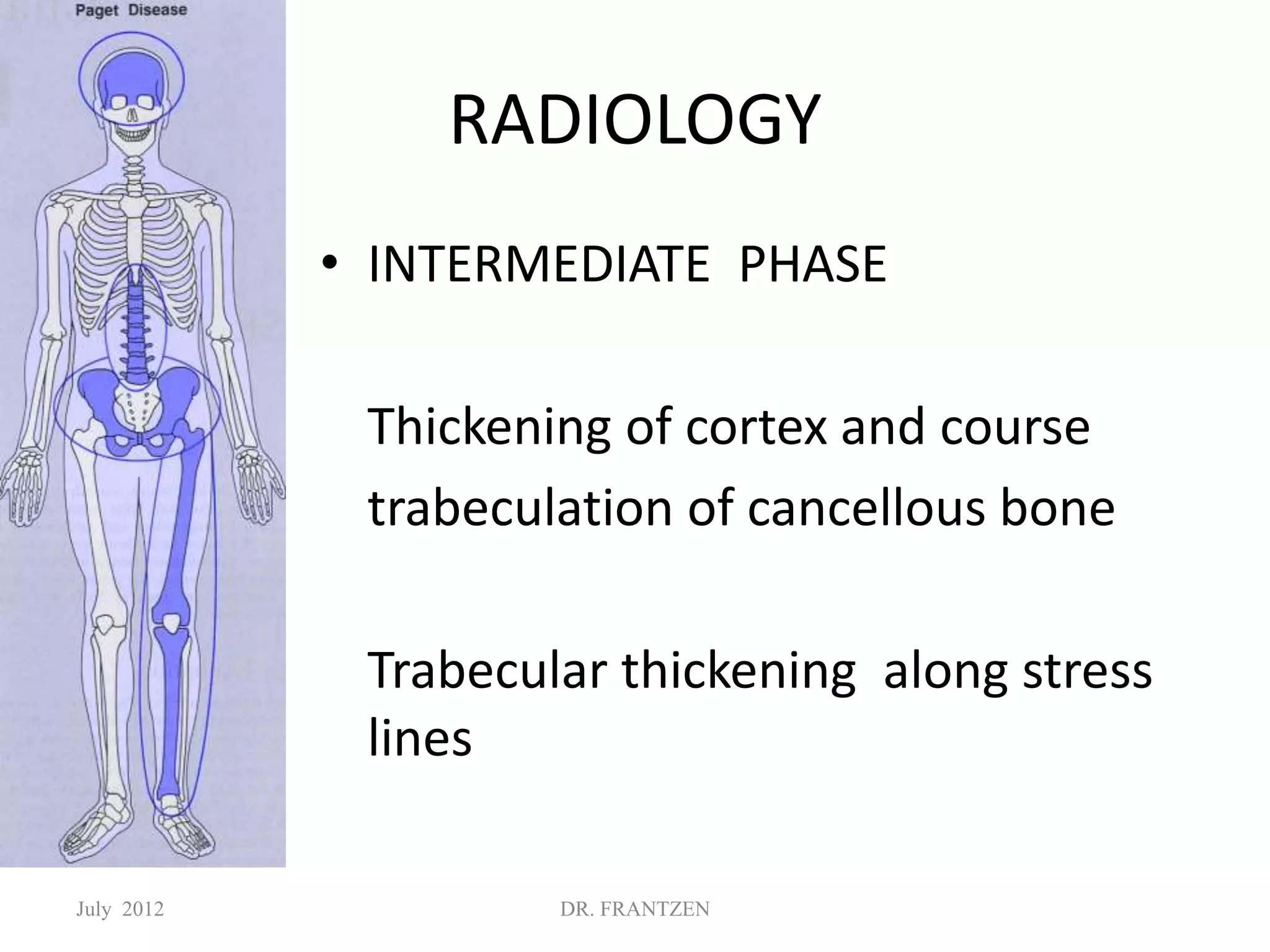 Paget disease .ppt