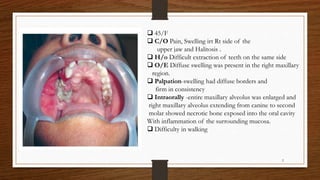 Pagets Disease Of The Jaw